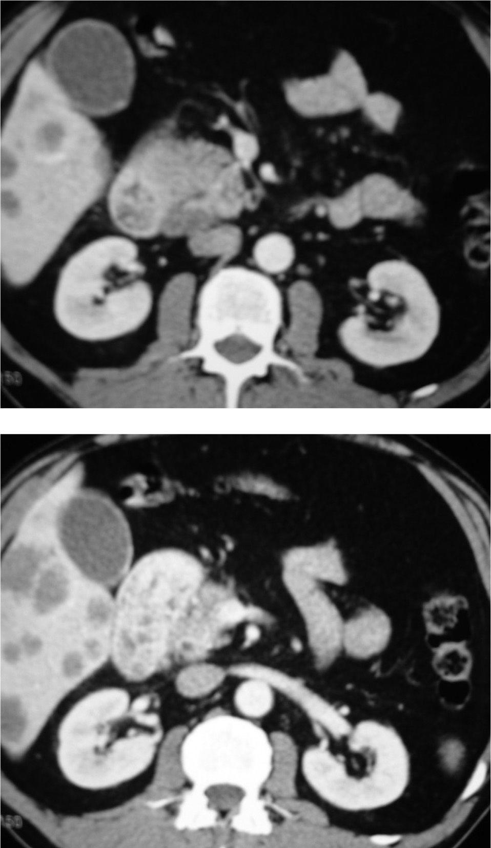Signo del tres invertido y pirosis | Revista Clínica Española