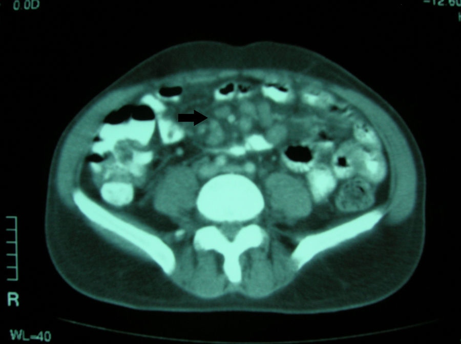 Ascitis quilosa secundaria a enfermedad de Whipple | Revista Clínica ...