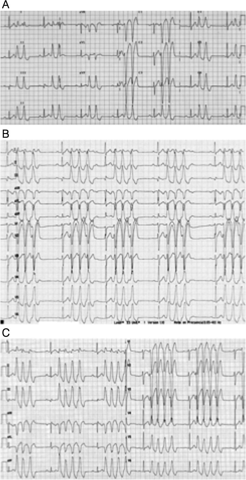 Arritmias ventriculares en bigeminismo continuo: una forma atípica de ...