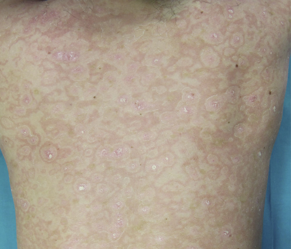 Eritema gyratum repens: no siempre una enfermedad paraneoplásica ...