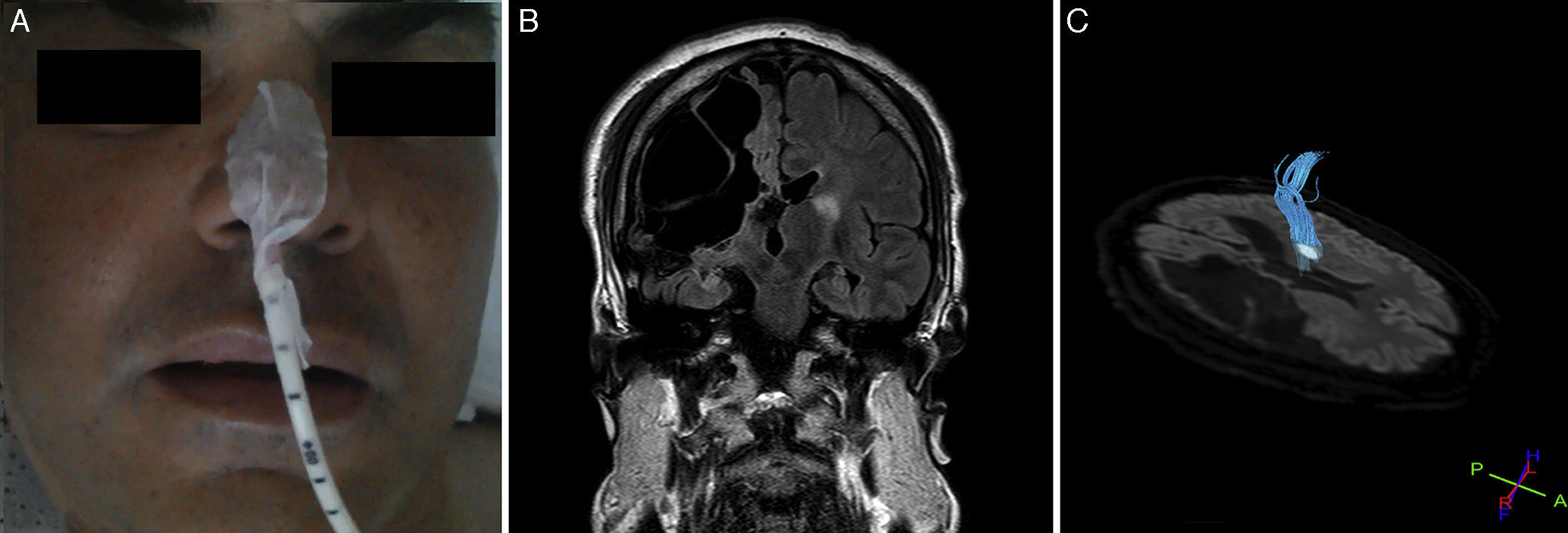 Diplejía facial y afagia de aparición súbita | Revista Clínica Española