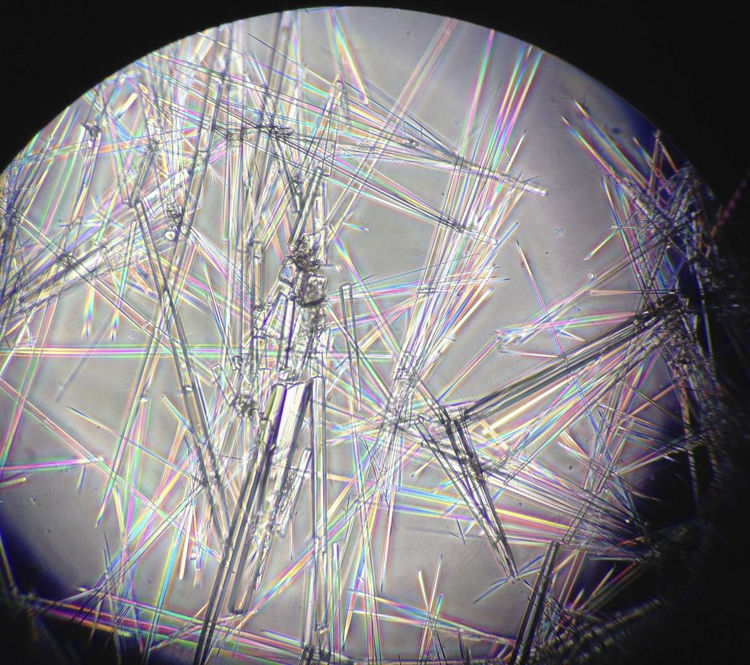 Cristaluria causada por amoxicilina | Revista Clínica Española