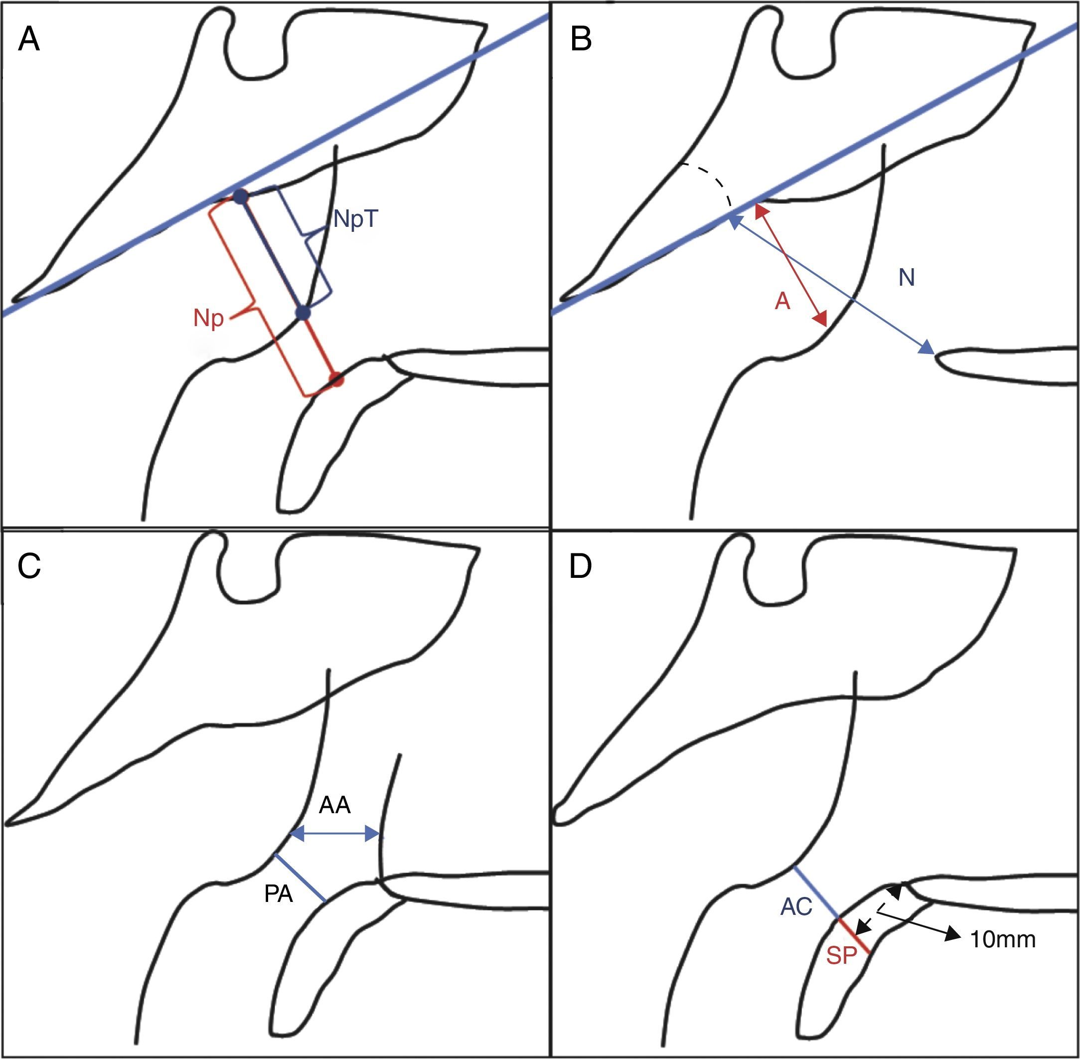 adenoid x ray normal