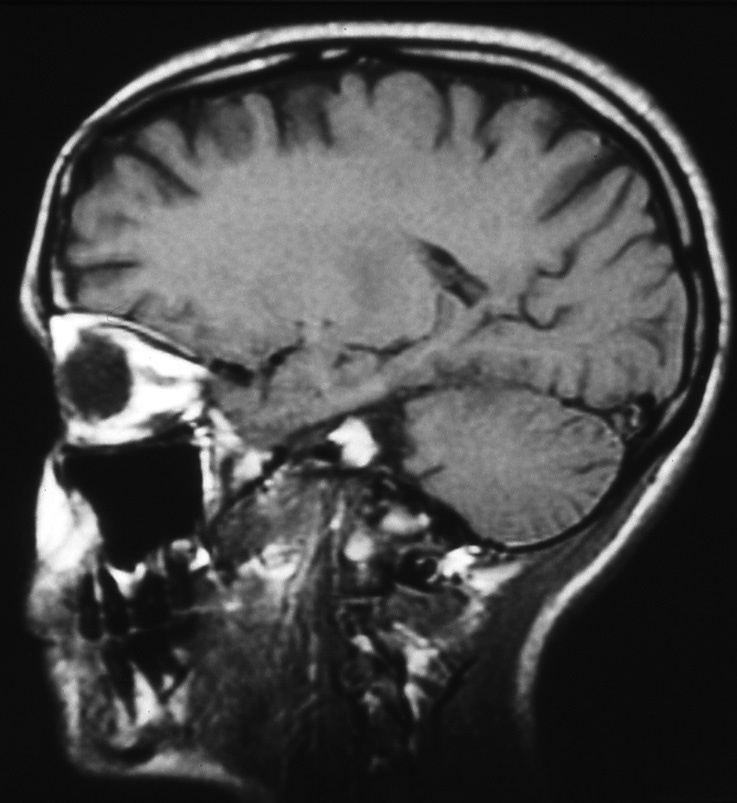 Anorexia nerviosa y atrofia cerebral en adolescentes | Medicina Clínica