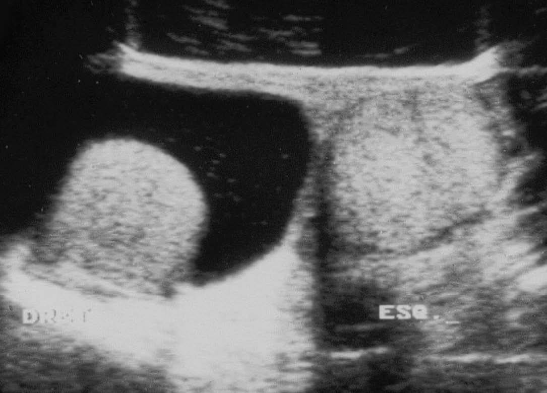 Hidrocele. Signo del «sol naciente». | Medicina Clínica
