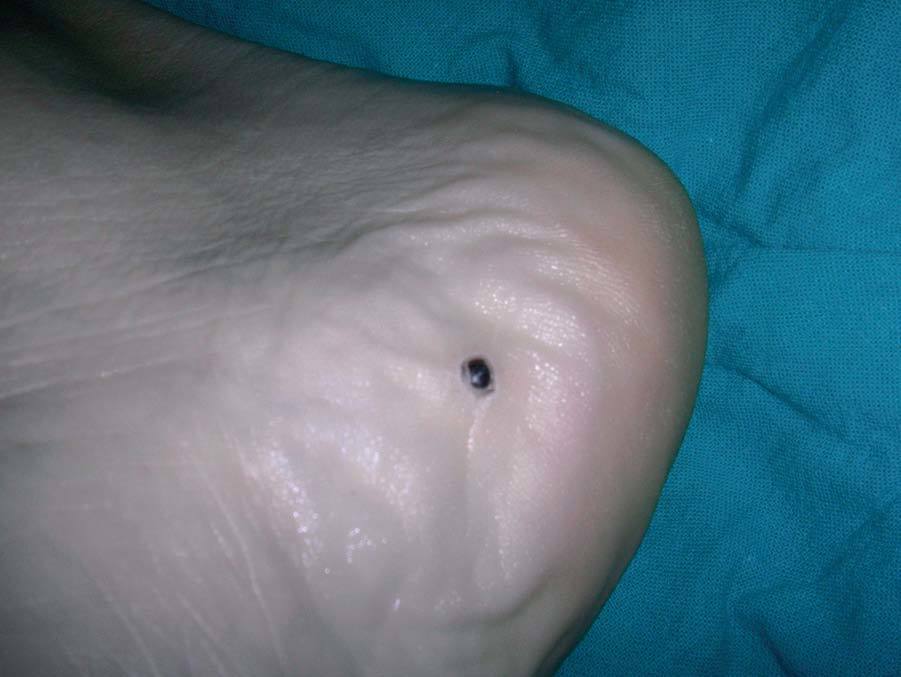 Tungiasis (Tunga penetrans). | Medicina Clínica