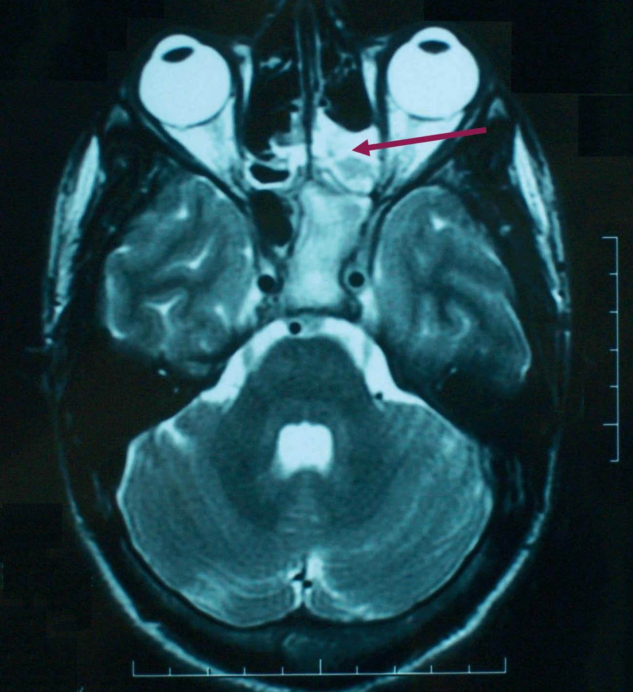 Sinusitis etmo-esfenoidal. | Medicina Clínica