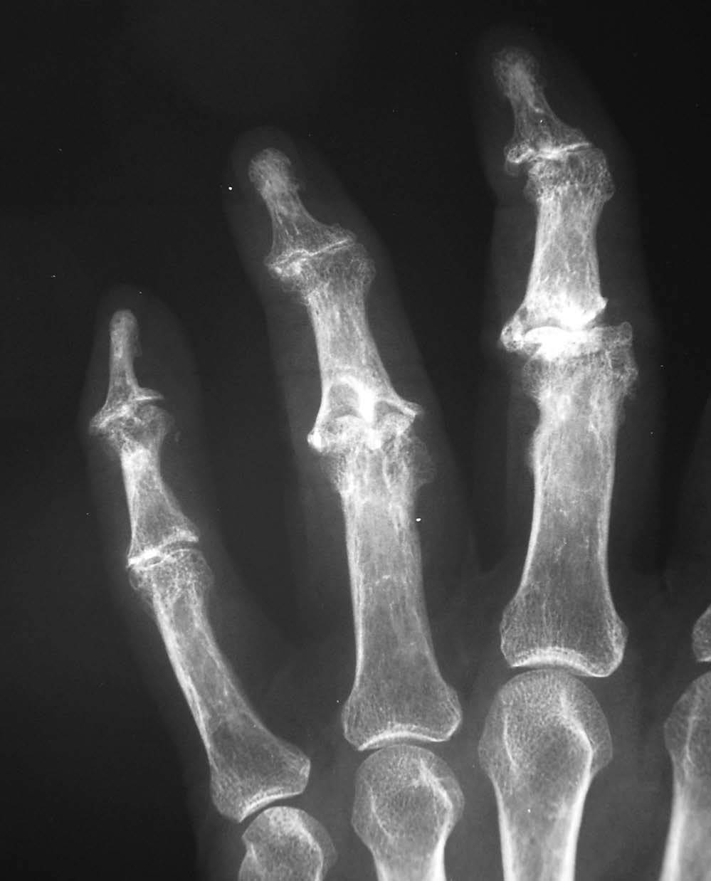 Artrosis erosiva o inflamatoria: la gran desconocida | Medicina Clínica