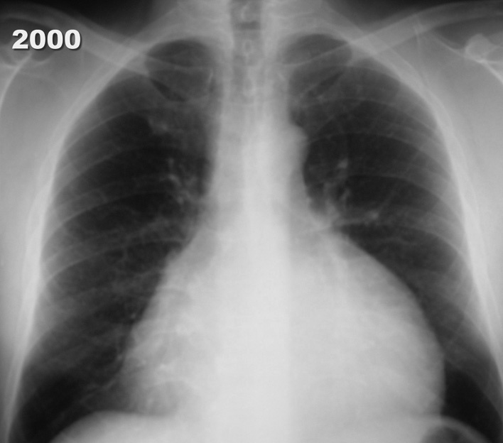 Corazón en garrafa. Taponamiento cardíaco | Medicina Clínica