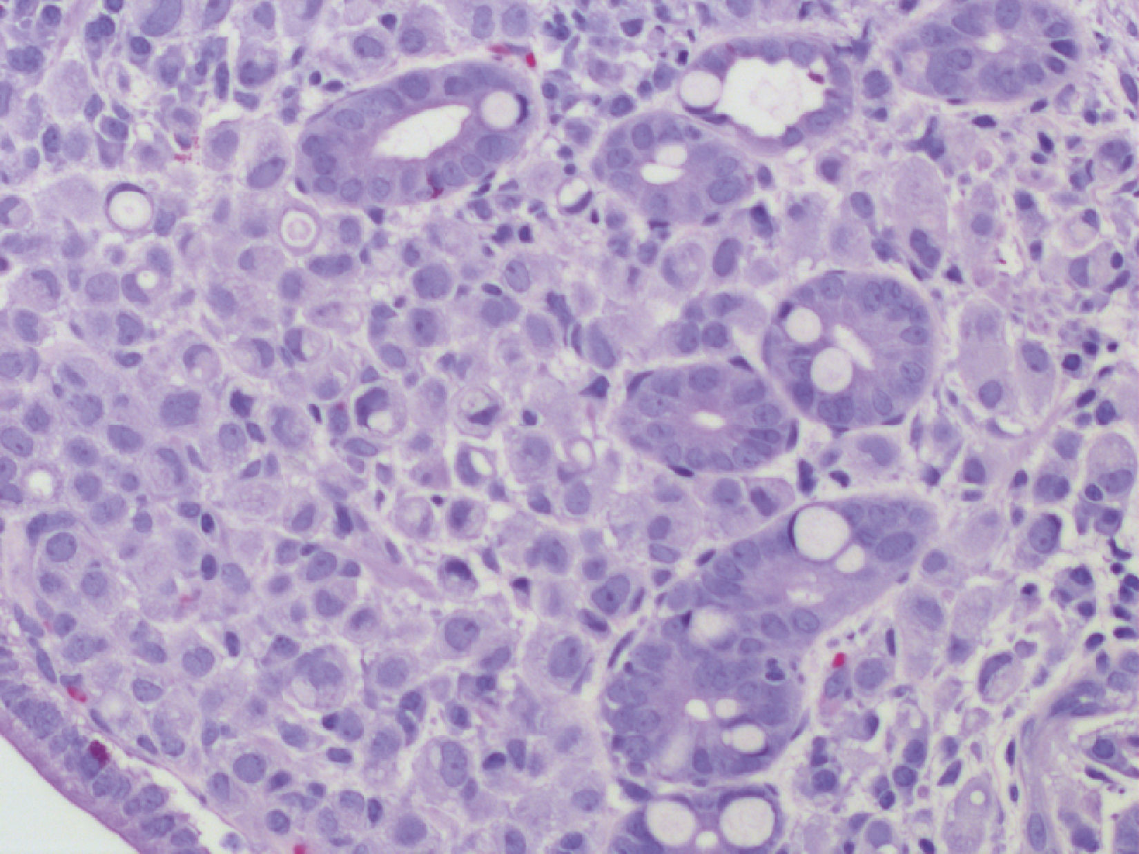 Linitis plástica gástrica y rectal como presentación de metástasis de ...