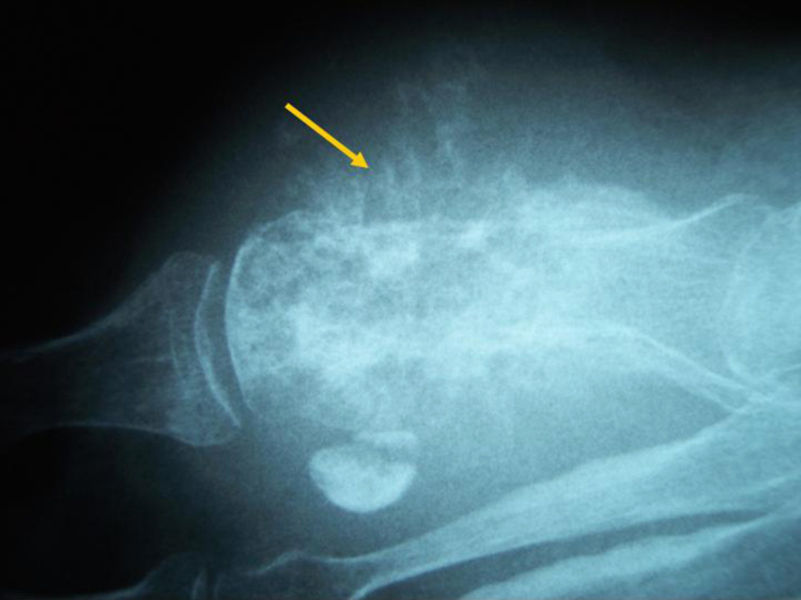Metástasis en el pie de un adenocarcinoma de colon | Medicina Clínica