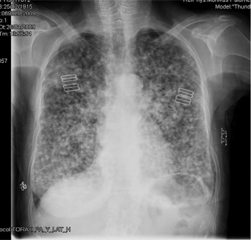 Patrón nodulillar pulmonar bilateral en mujer de 95 años | Medicina Clínica