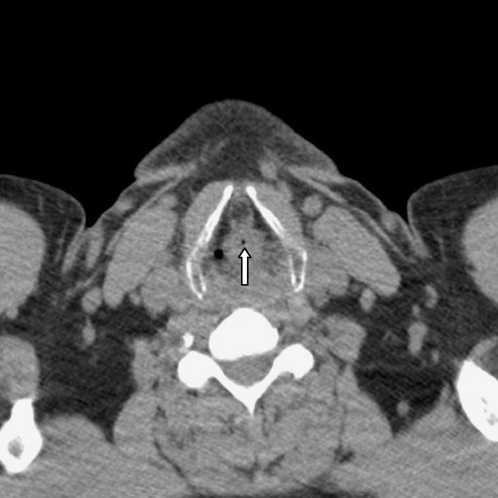Estenosis traqueal en la granulomatosis de Wegener | Medicina Clínica
