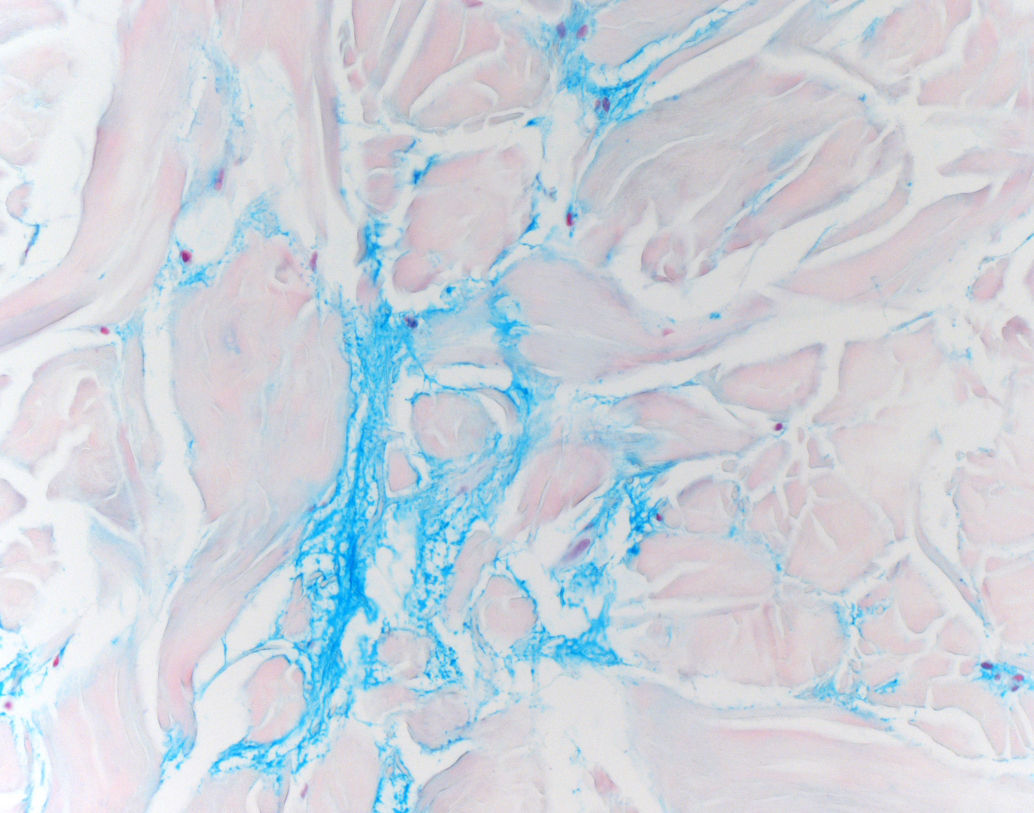 Placa indurada y asintomática en la espalda: escleredema de Buschke ...