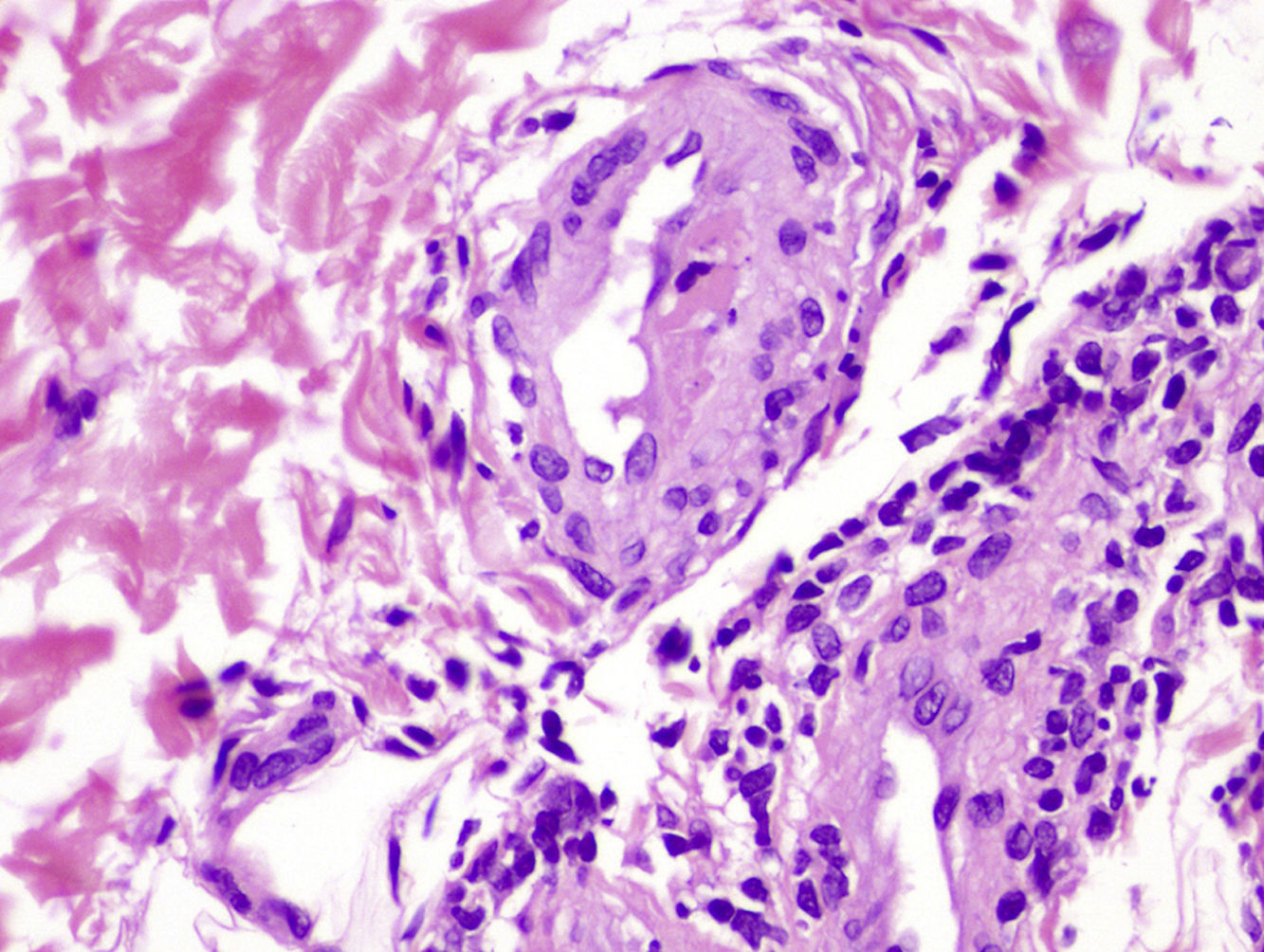 Livedo racemosa como signo de presentación de un síndrome ...