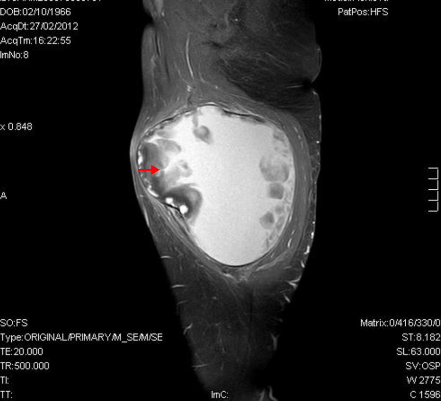 Tumoración gigante como forma de presentación tardía de una mionecrosis ...