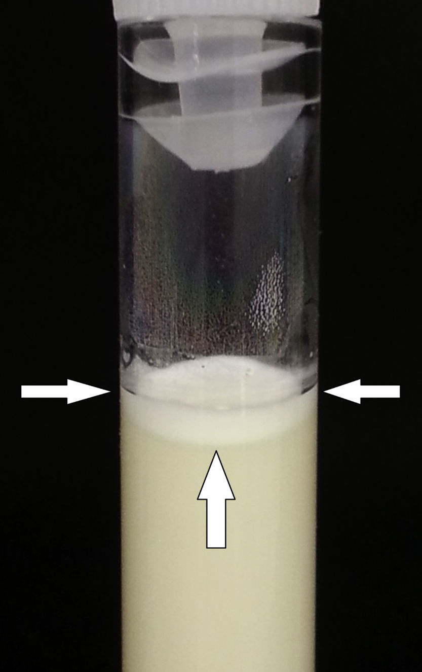 Ascitis quilosa | Medicina Clínica
