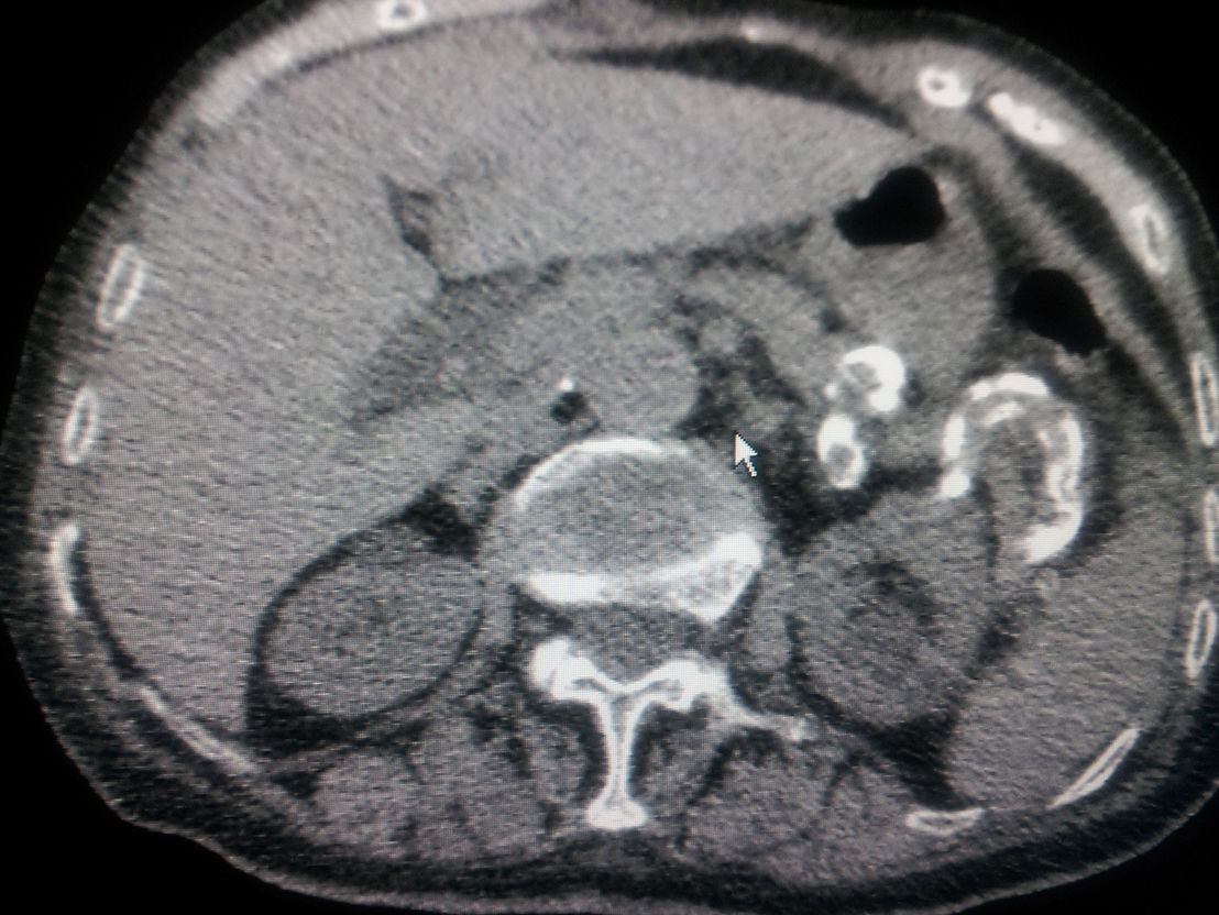 Calcificación de la arteria esplénica | Medicina Clínica