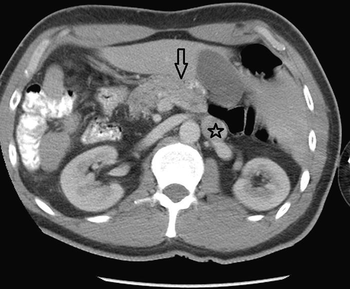 Situs ambiguous o heterotaxia | Medicina Clínica