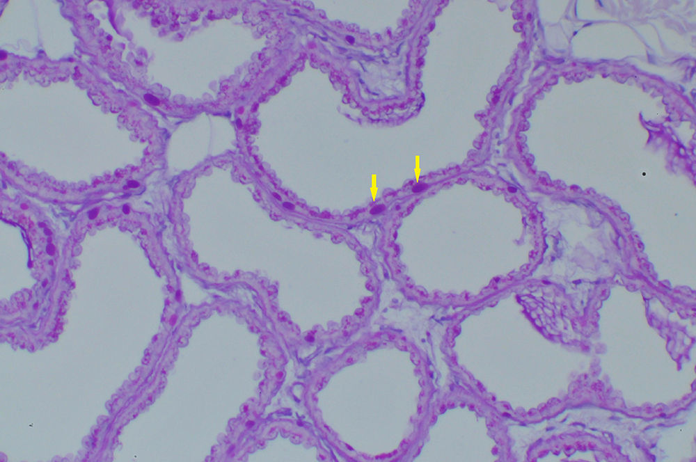 Diagnóstico de enfermedad de Lafora mediante biopsia cutánea de piel ...