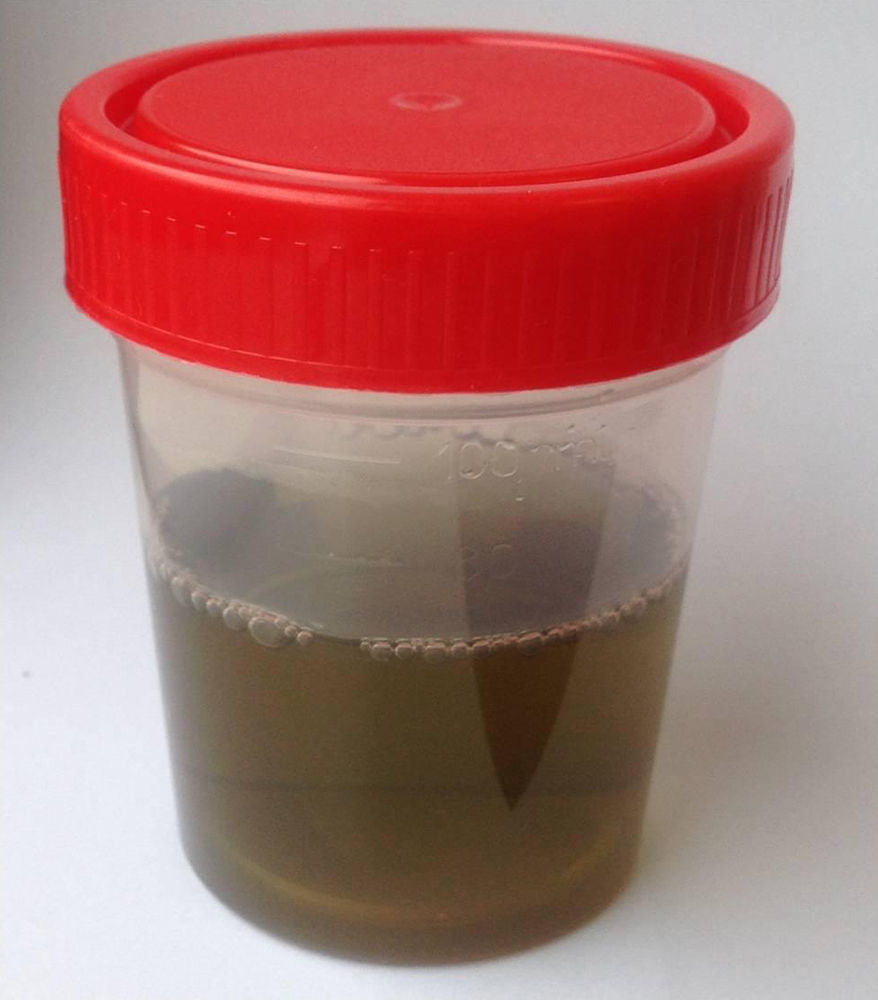 Orina verde secundaria a propofol | Medicina Clínica