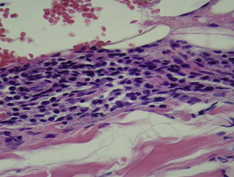 Signo del surco y engrosamiento de la fascia en la fascitis ...