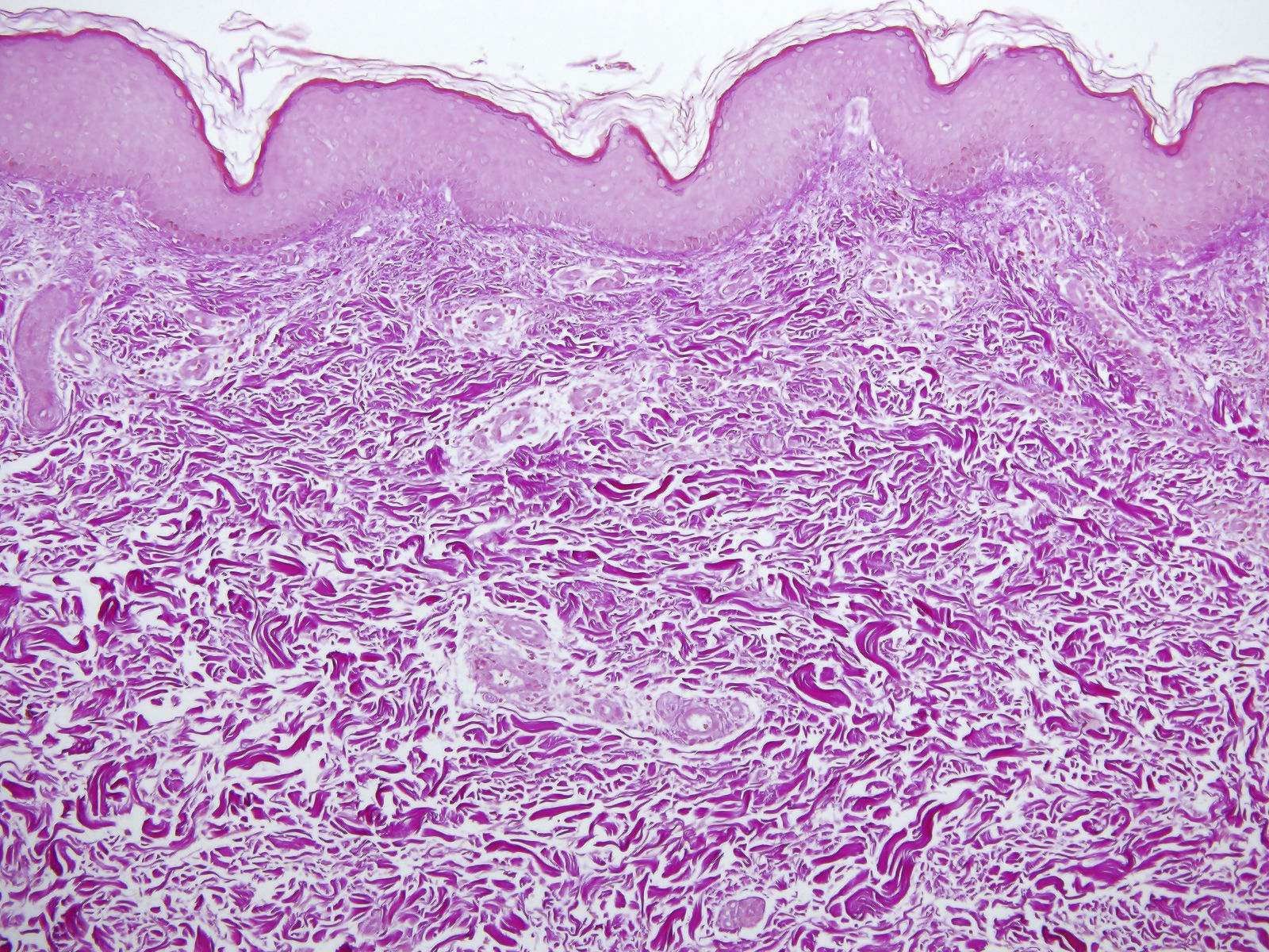 Anetodermia primaria: un marcador cutáneo de estados protrombóticos ...