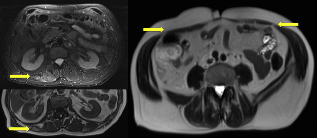 Signo de Beevor «extendido». Un nuevo signo clínico en miositis con ...