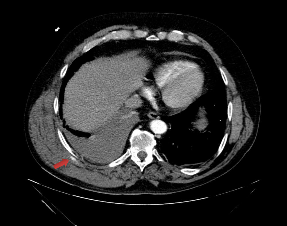 Hemorragia intercostal secundaria a tos persistente en un caso de ...