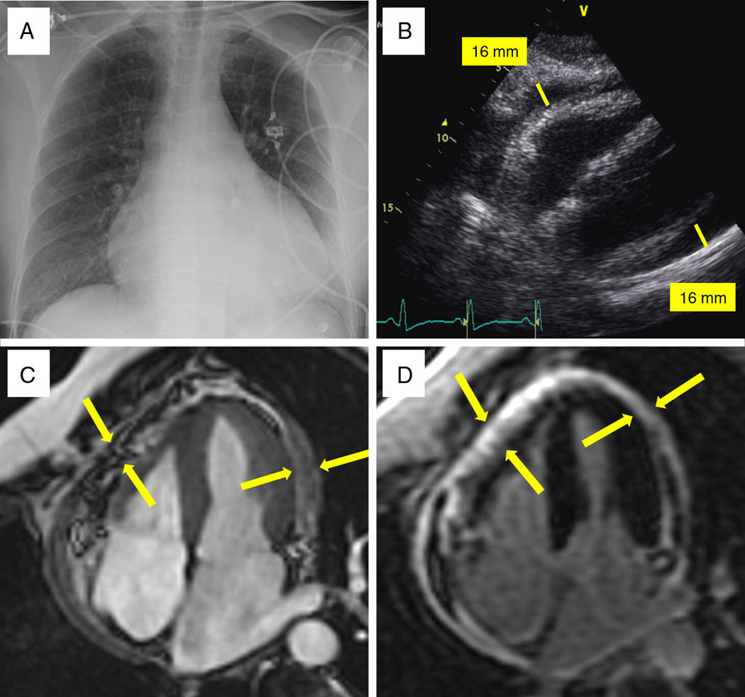 Granulomatosis eosinofílica con poliangitis (Churg-Strauss) y derrame ...