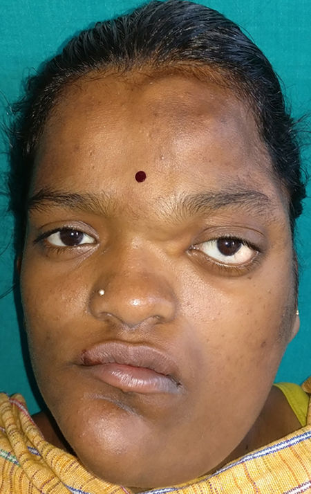 Congenital hemifacial hyperplasia | Medicina Clínica