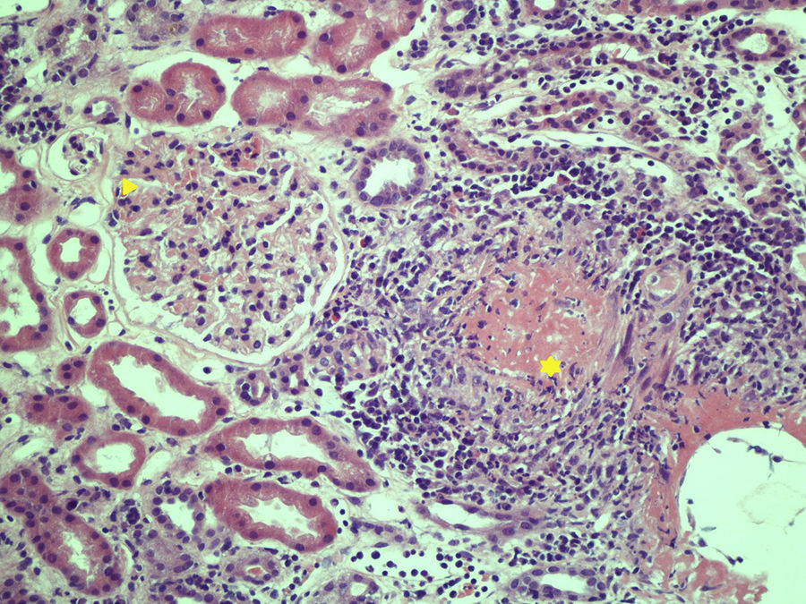 Poliangitis microscópica y enfermedad pulmonar intersticial | Medicina ...
