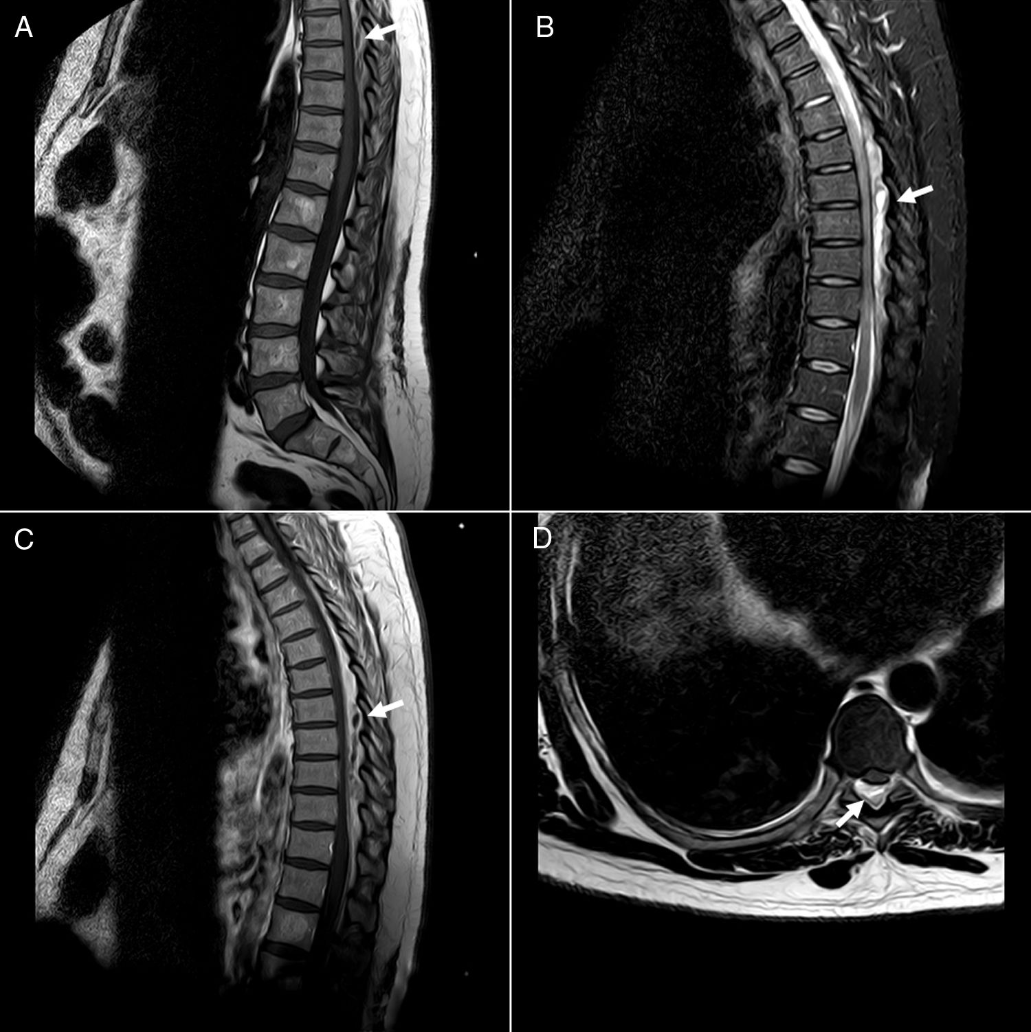 Absceso epidural espinal por Streptococcus agalactiae en un paciente ...