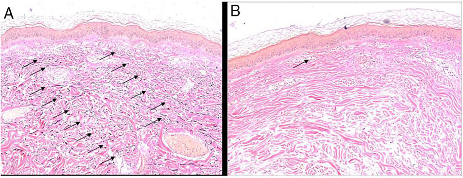 Anetodermia asociada a síndrome antifosfolipídico | Medicina Clínica