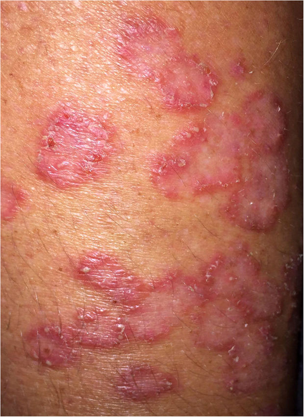 Psoriasis pustulosa anular | Medicina Clínica