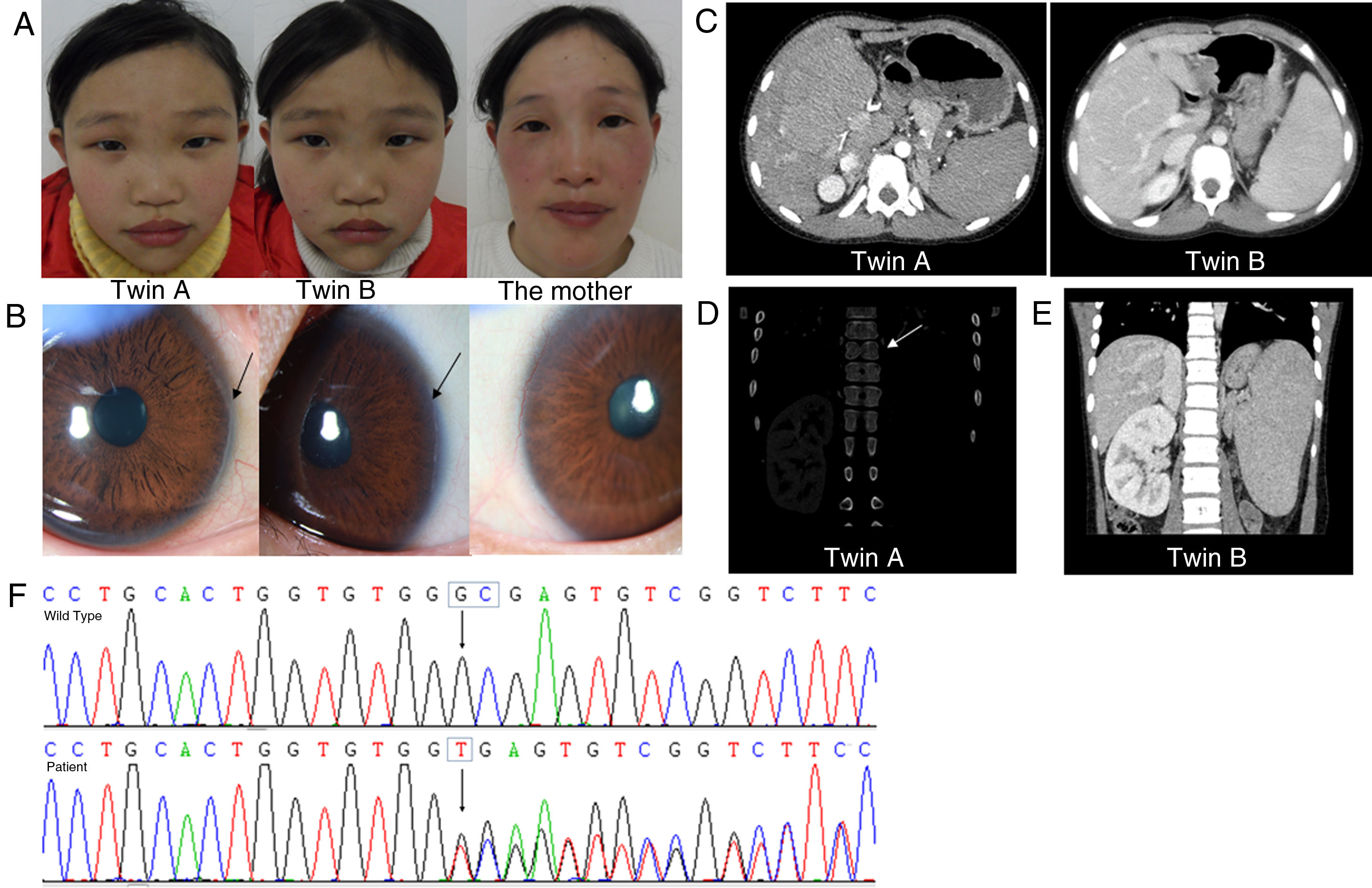 A novel JAG1 mutation causing Alagille syndrome presenting with giant ...