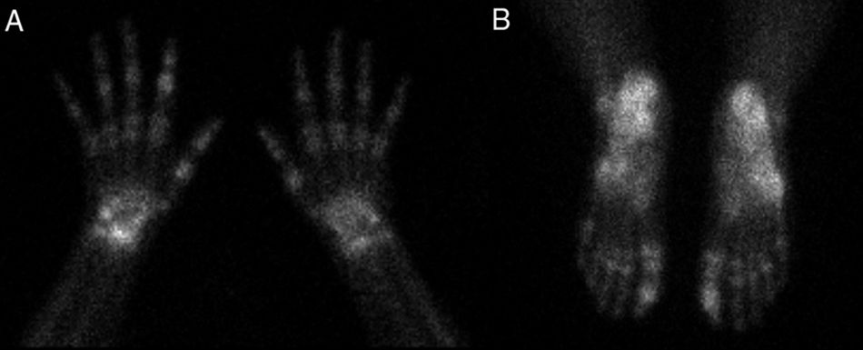 Síndrome PAPASH con mutación en el gen MEFV | Medicina Clínica