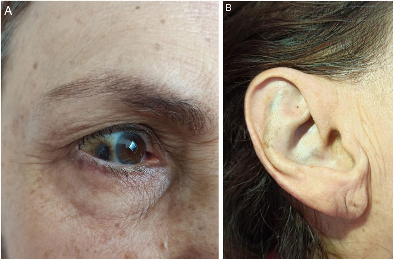 The “dark side” is the key. Ochronosis by alkaptonuria | Medicina Clínica