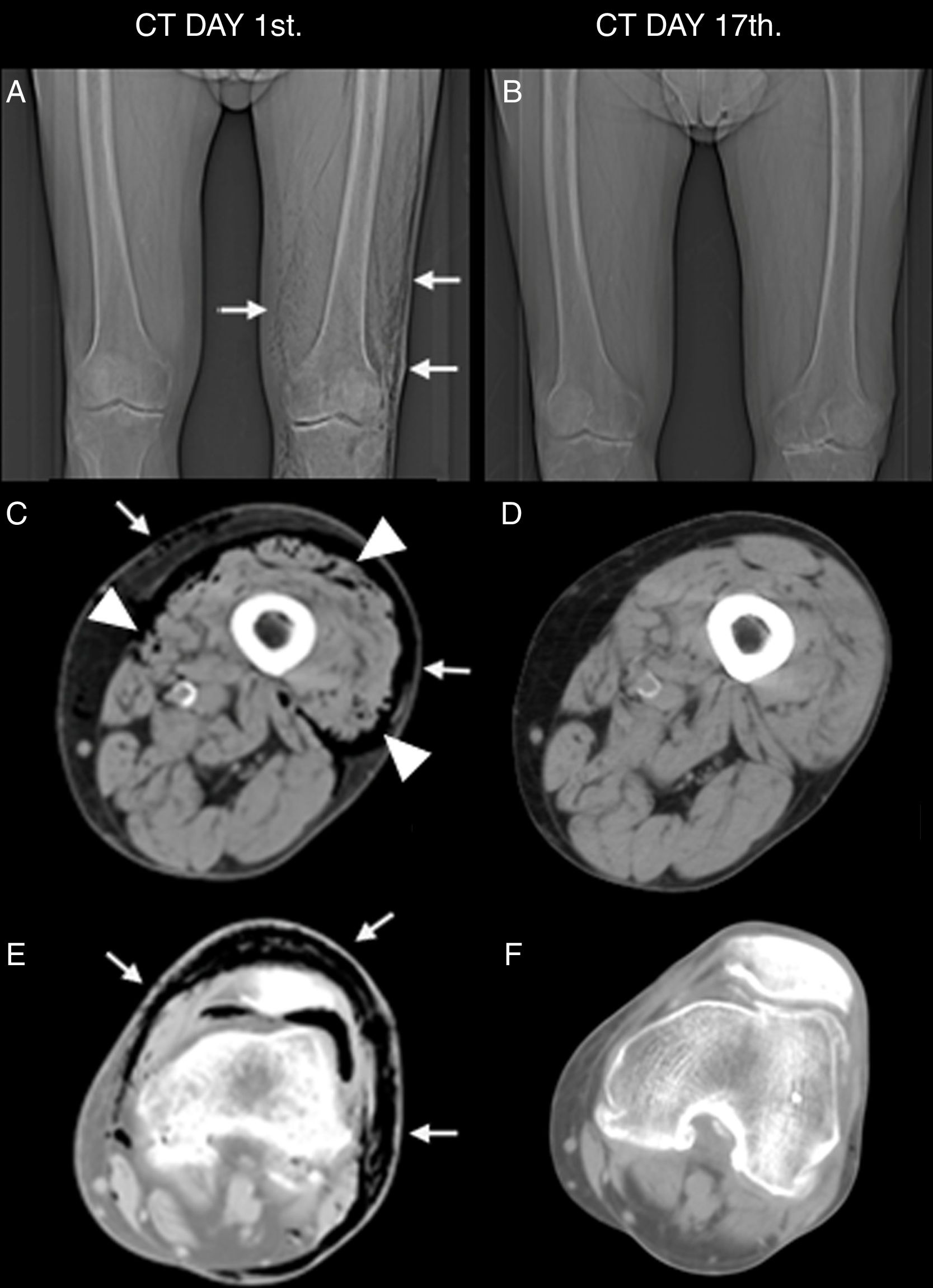 Delayed soft tissue emphysema of the leg following arthroscopy of the ...