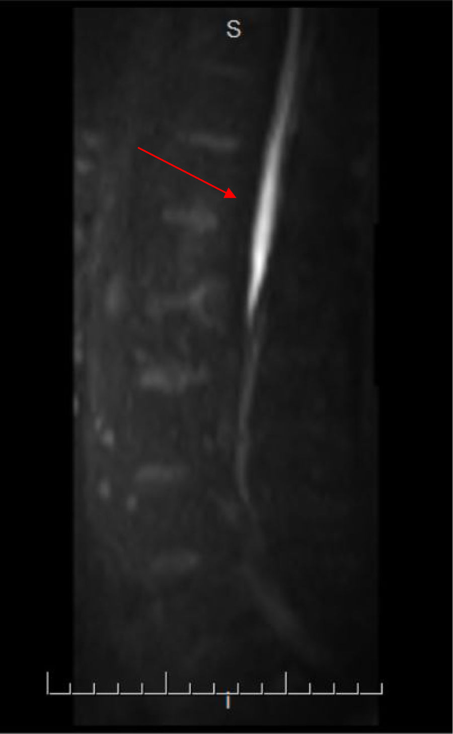 Isquemia medular tras parada cardiaca | Medicina Clínica