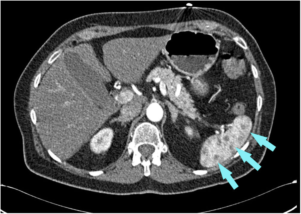 Isolated splenic tuberculosis in an immunocompetent patient | Medicina ...