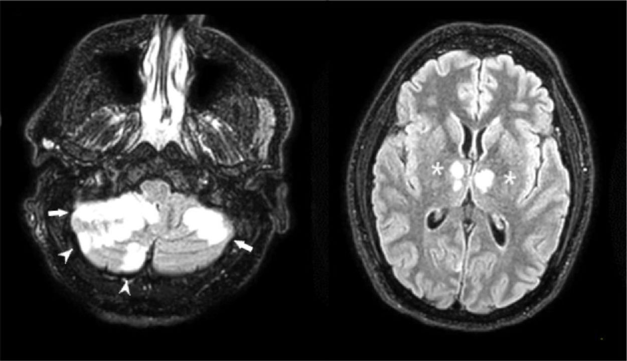 Disección vertebral espontánea que imita una rombencefalitis | Medicina ...