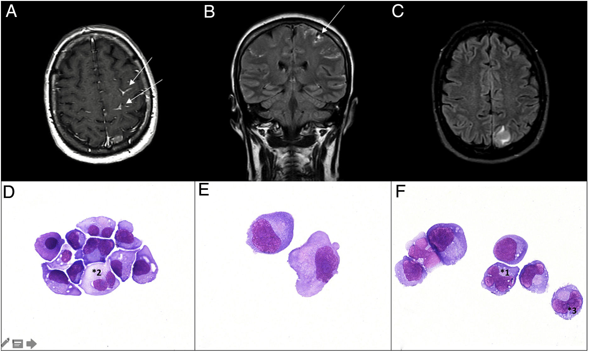 Recaída extramedular de mieloma múltiple con diseminación leptomeníngea ...