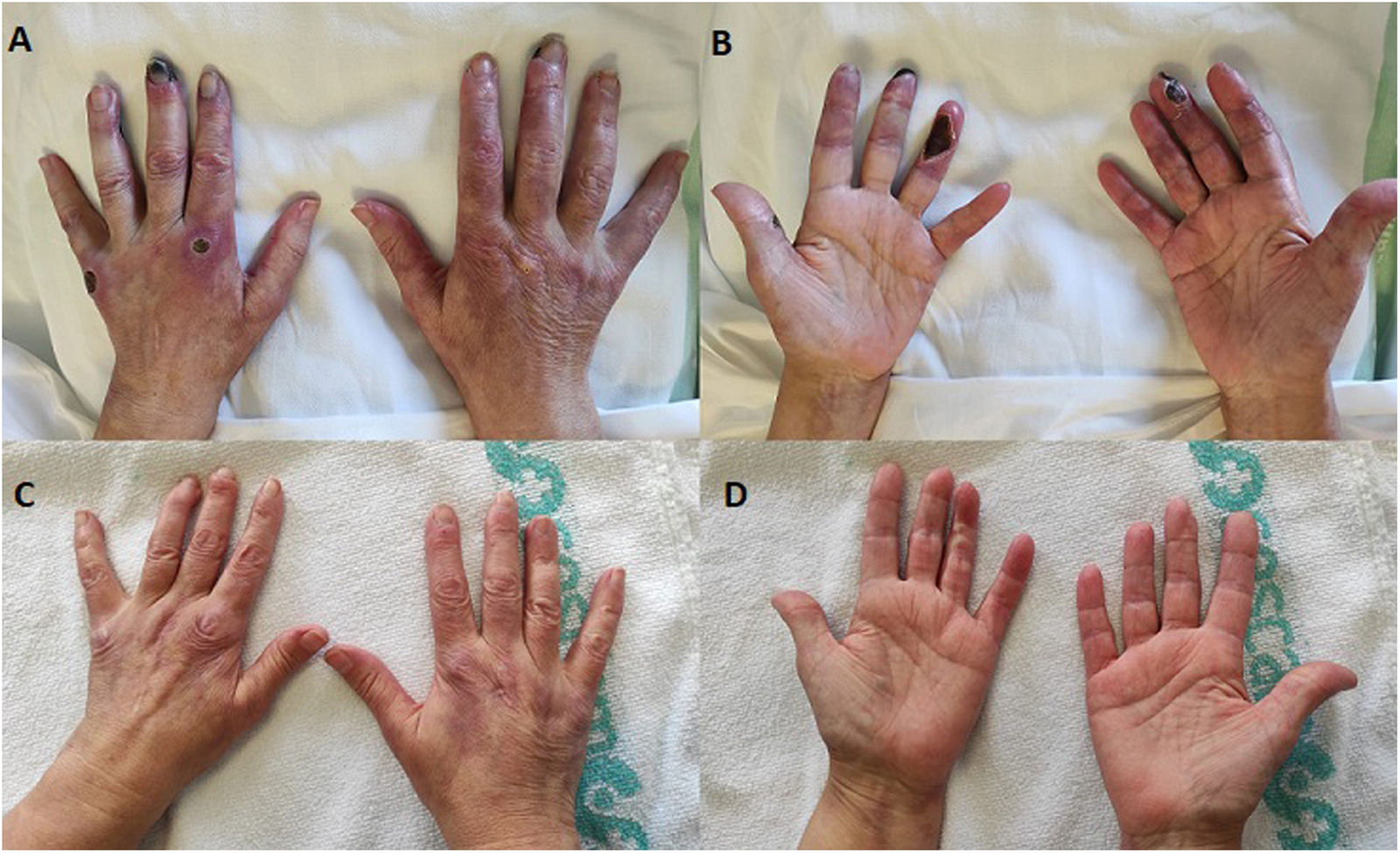 Úlceras cutáneas asociadas a dermatomiositis MDA5 | Medicina Clínica