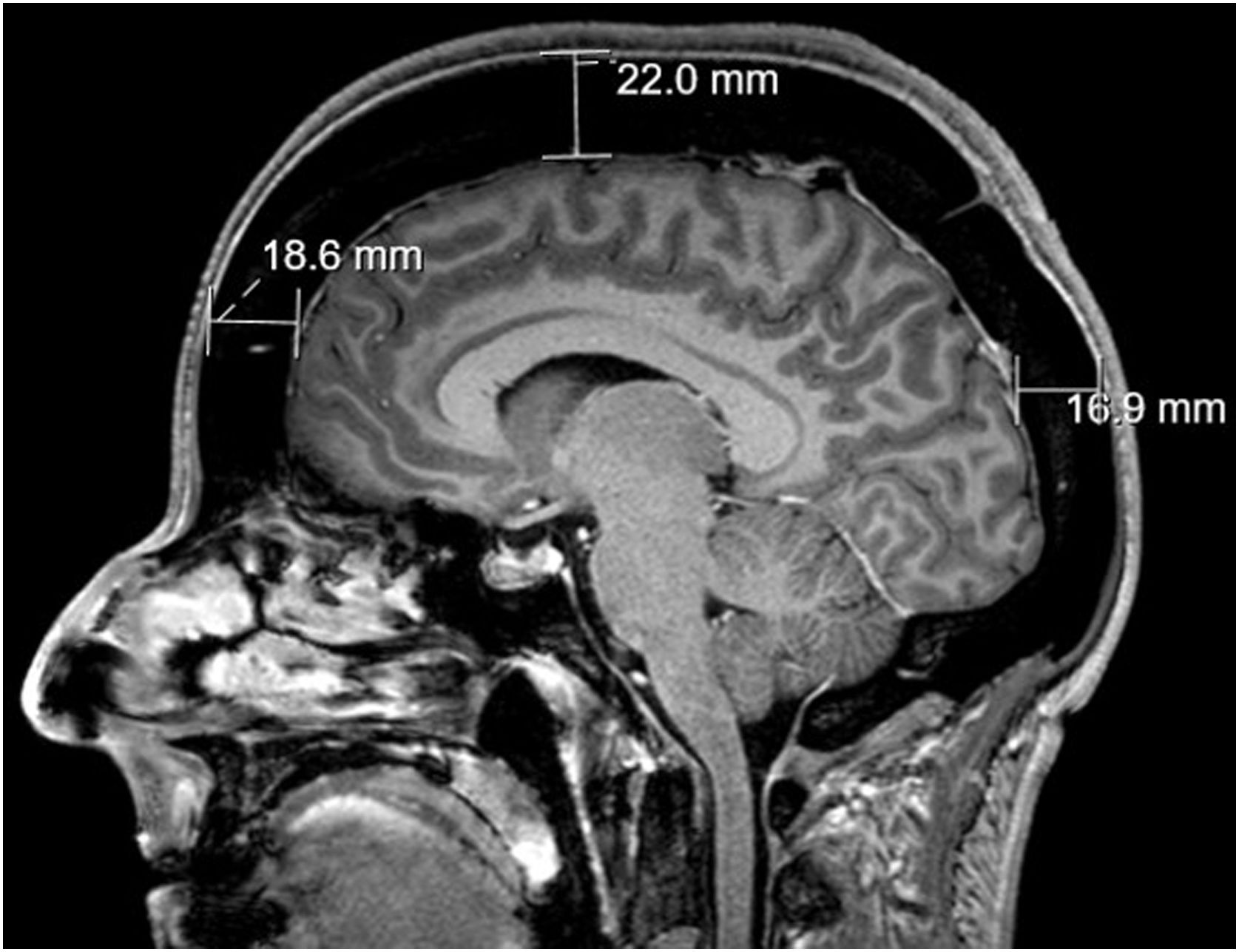 Calvaria thickening in acromegaly | Medicina Clínica