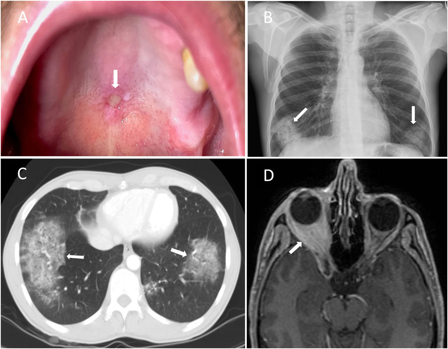 Vasculitis asociada a ANCA | Medicina Clínica