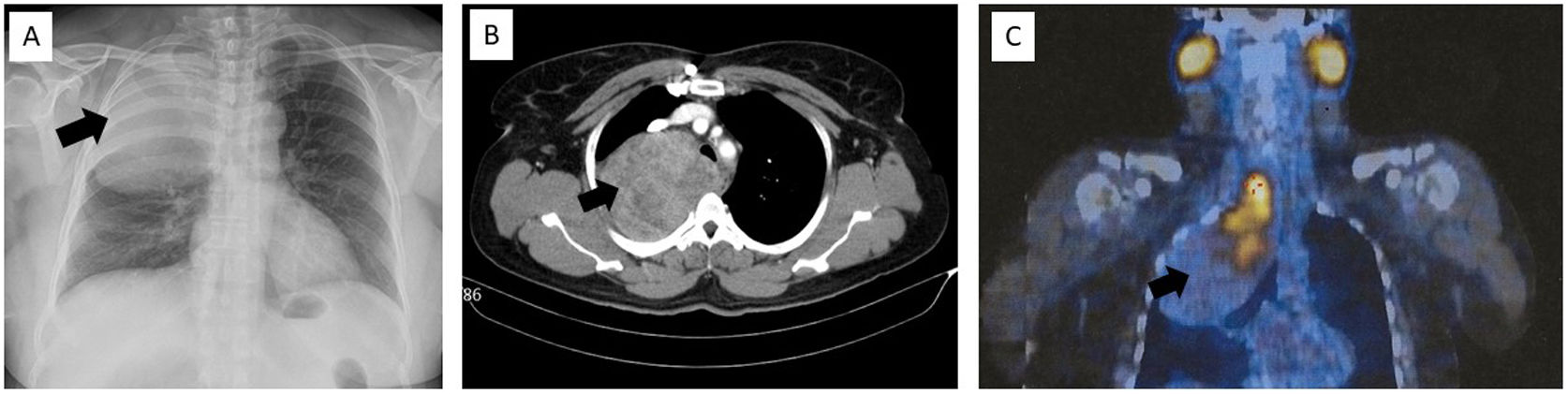 Huge intrathoracic goiter presenting with dyspnea and dysphagia ...