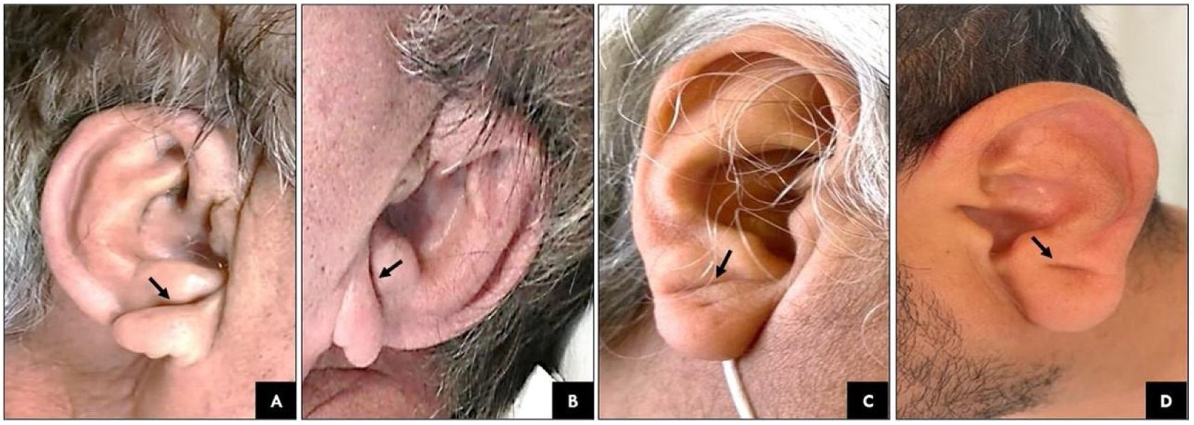 Frank's sign associated with the severity of ischemic heart disease in ... Frank's sign associated with the severity of ischemic heart disease in ...