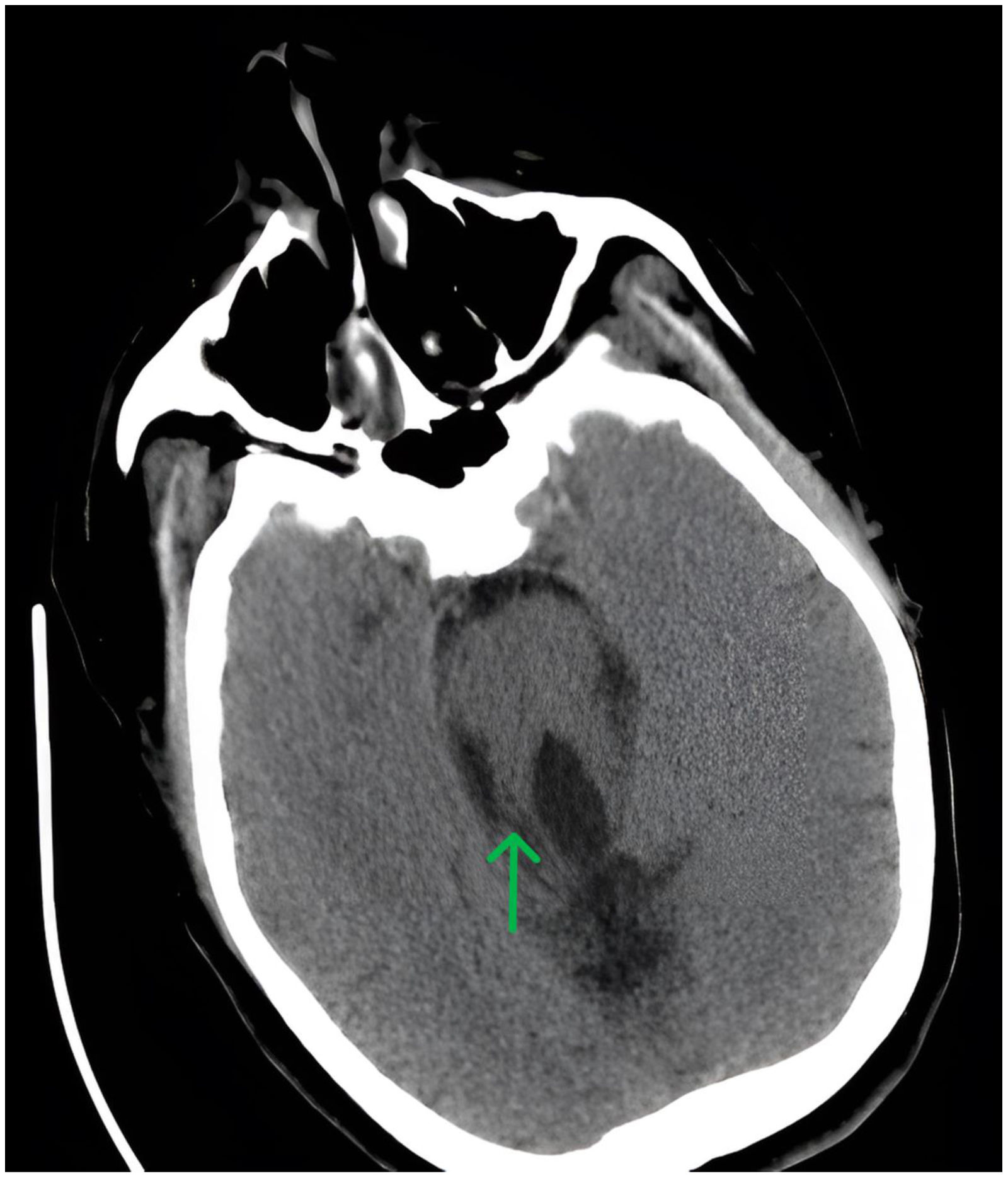 A case with Joubert syndrome diagnosed at an advanced age | Medicina ...