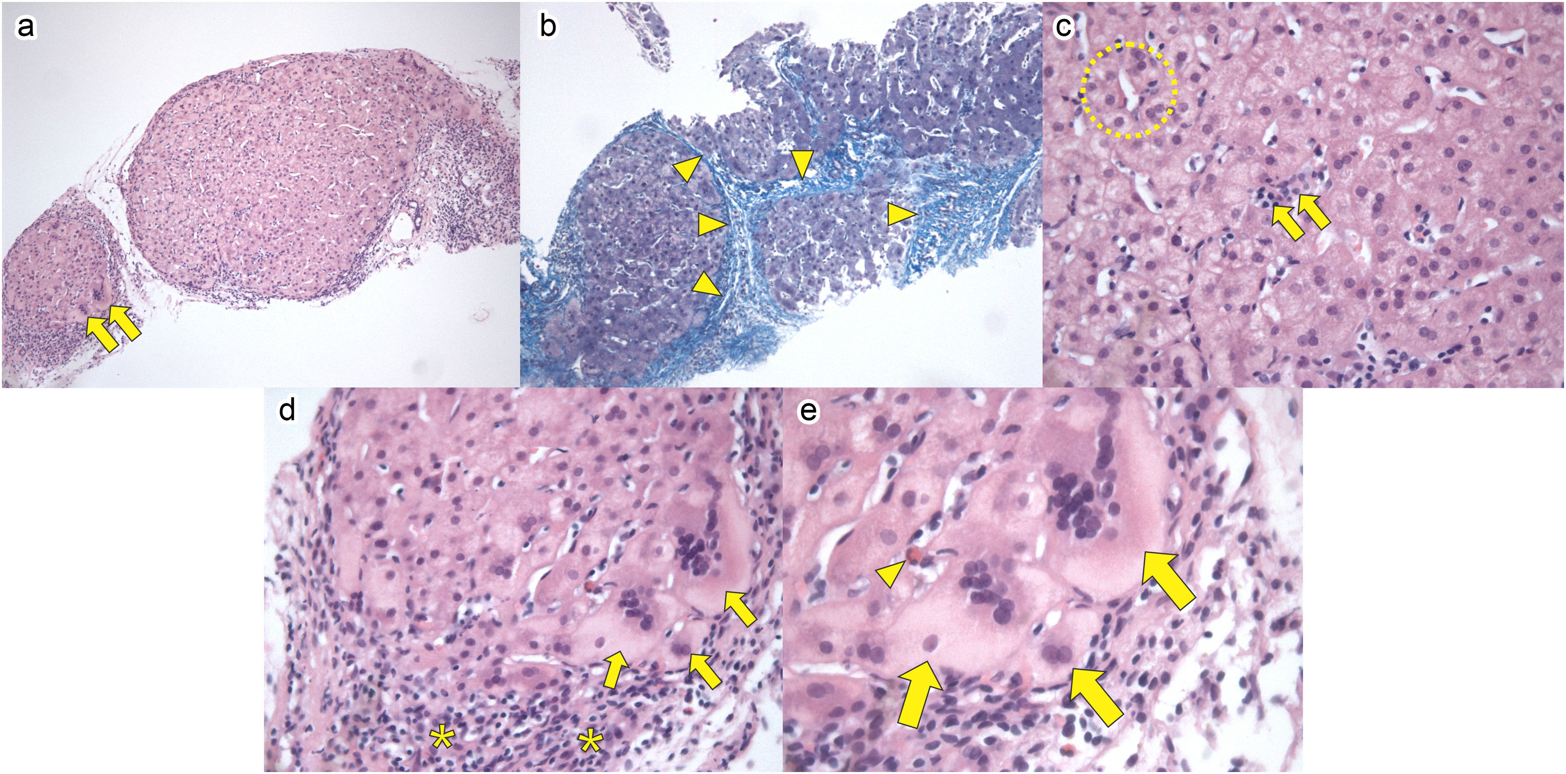 Post-infantile giant cell hepatitis | Medicina Clínica